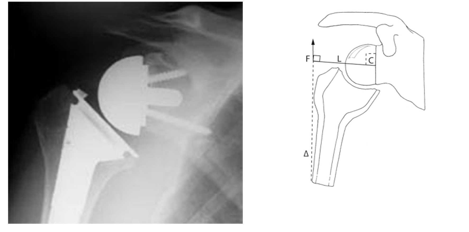 Schouder | Orthoteam Limburg